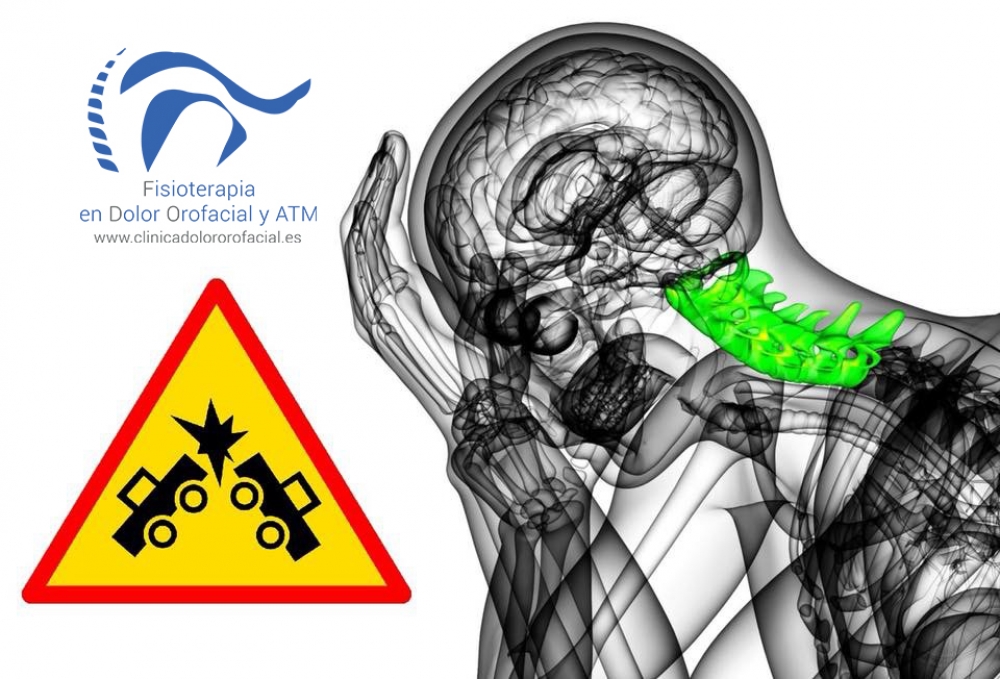 whiplash o Sindrome del latigazo cervical - Clinica Dolor Orofacial