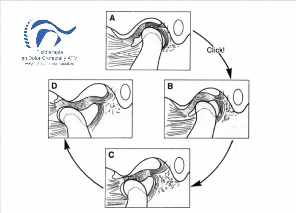 Articulación tempormandibular: causas, características y patologías