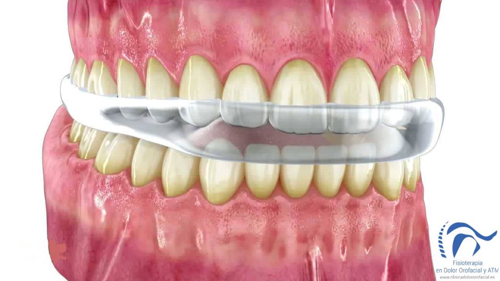 Bruxismo, consecuencias y posibles tratamientos - Clinica Dolor Orofacial